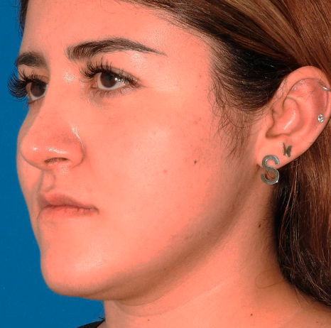 Cirugía de pómulos | Topmedical