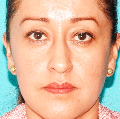 Cirugía de labios | Topmedical