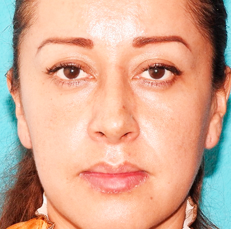 Cirugía de labios | Topmedical