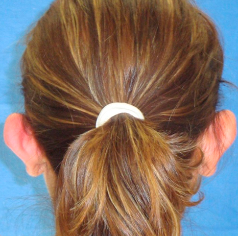 Cirugía de orejas | Topmedical