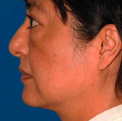 Cirugía de pómulos | Topmedical