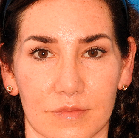 Cirugía de labios | Topmedical