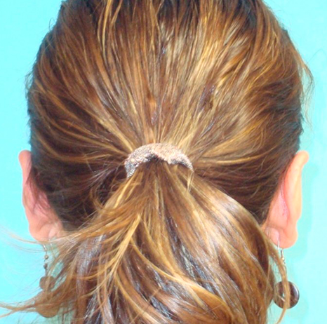 Cirugía de orejas | Topmedical