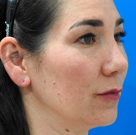 Cirugía de labios | Topmedical