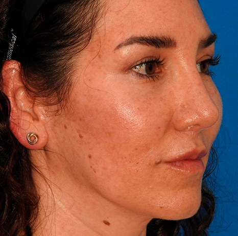 Cirugía de labios | Topmedical