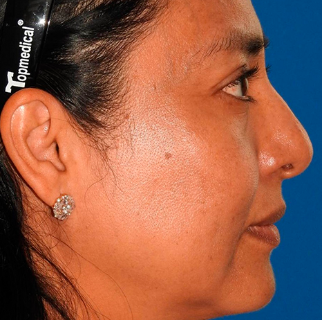 Cirugía de pómulos | Topmedical
