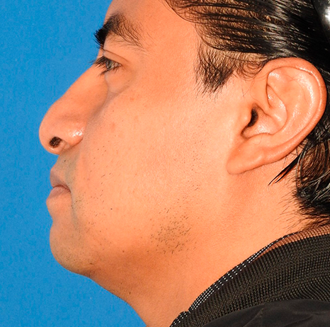 Cirugía de pómulos | Topmedical