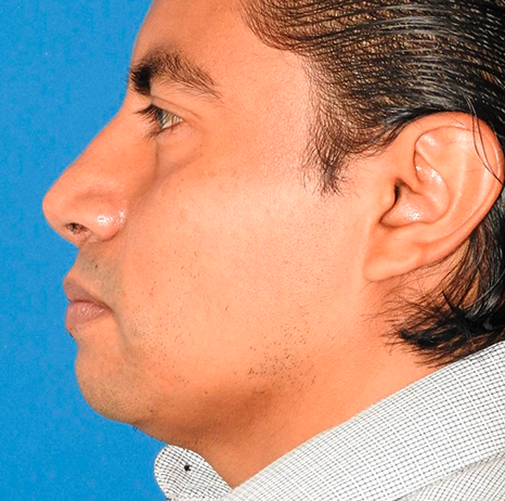 Cirugía de pómulos | Topmedical