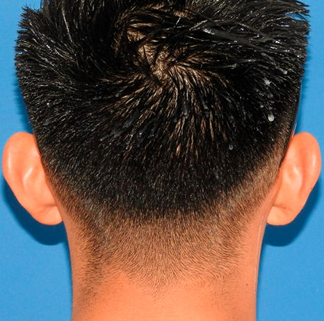 Cirugía de orejas | Topmedical