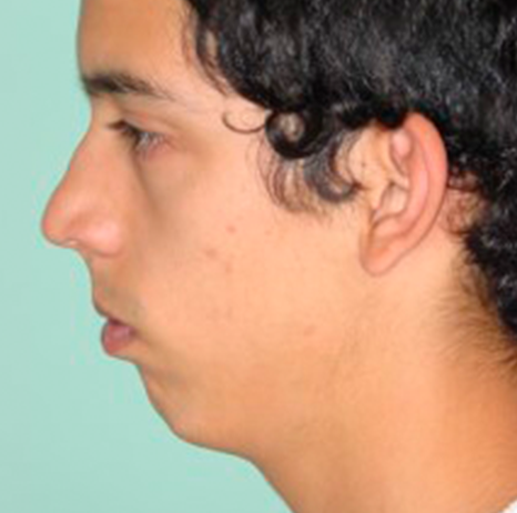 Cirugía de mentón | Topmedical