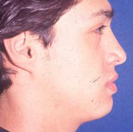 Cirugía de mentón | Topmedical