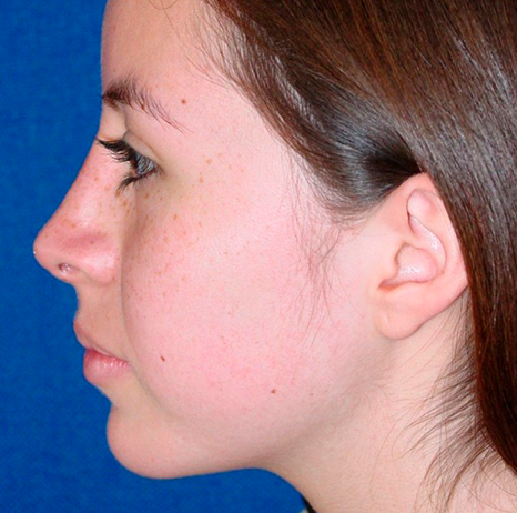 Cirugía de mentón | Topmedical